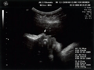 The Bub in the Belly: Scan at 32 weeks