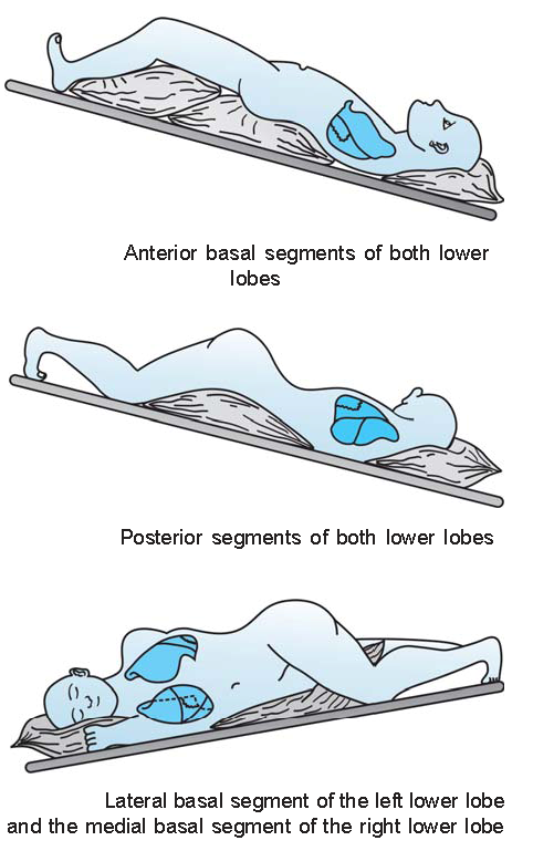 Physioteach: POSTURAL DRAINAGE POSTIONS