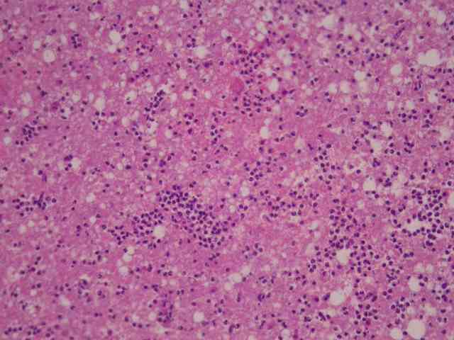 AS PATOLÓGICAS: Inflamação supurativa ou purulenta