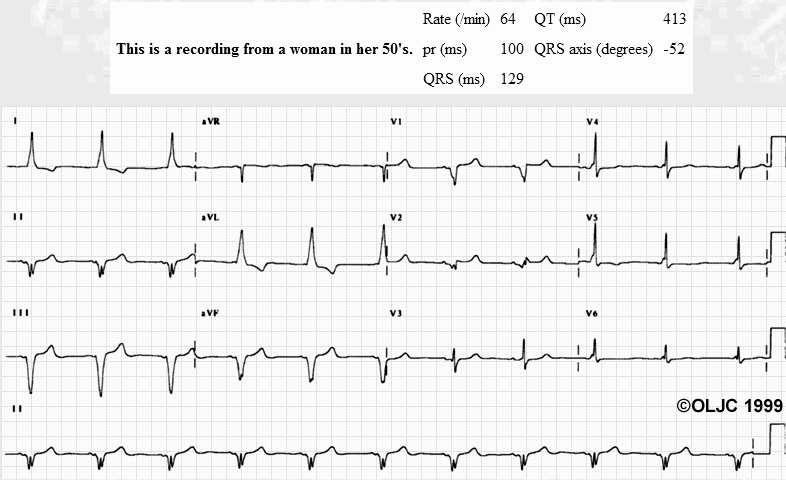 Wpw Syndrome