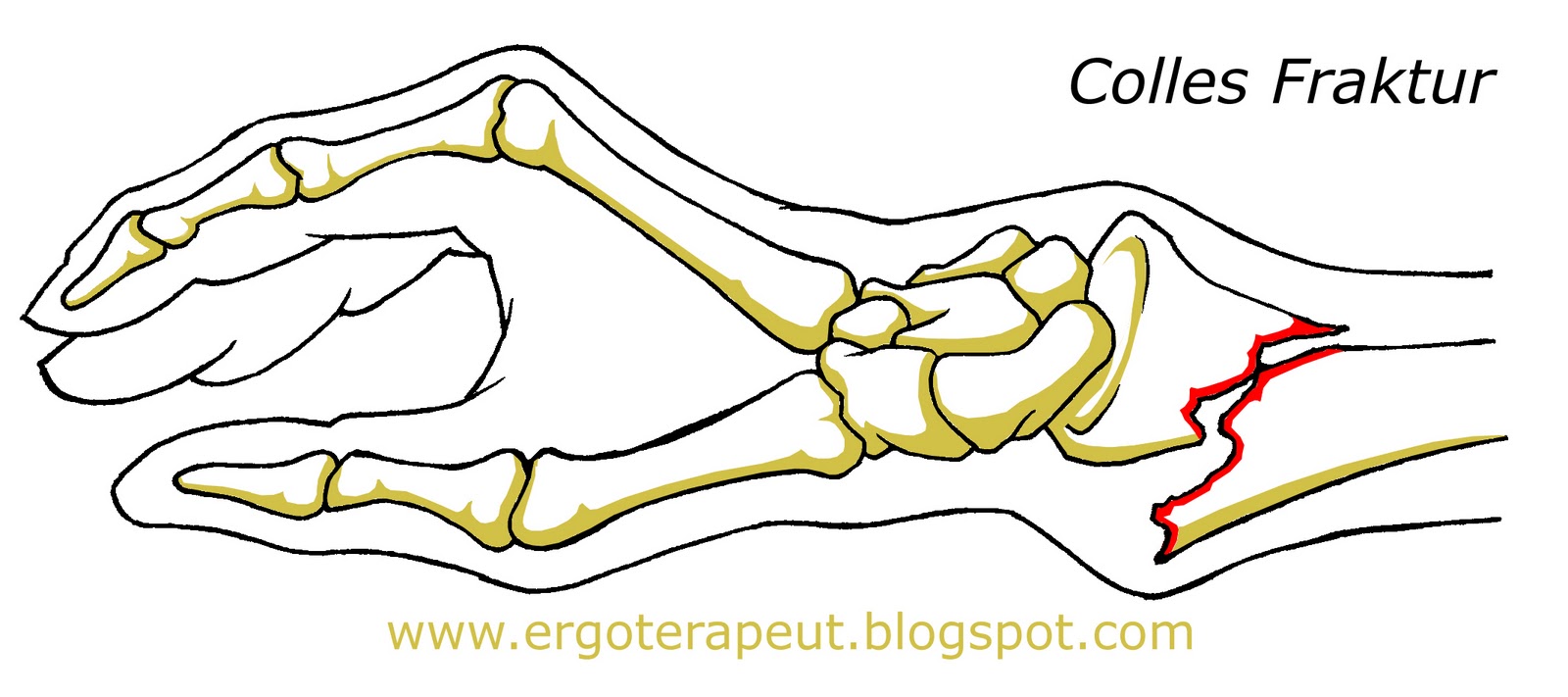 ergoterapeut: Colles Fraktur