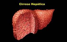 Saúde Digestiva e Bem-Estar: CIRROSE HEPÁTICA - Seria o álcool a única ...
