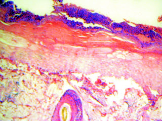 herenciageneticayenfermedad: aftosis compleja - estomatitis aftosa ...