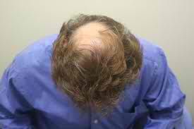 "How to Experience Natural Hair Growth": Five Steps to Repairing Crown ...