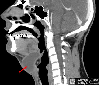 CT/MRI procedures: GOITER