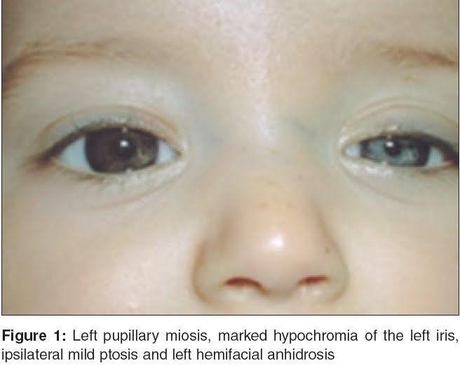 free medical stuff for students: horner syndrome