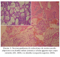 conhecendopatologia: Necrose Gordurosa