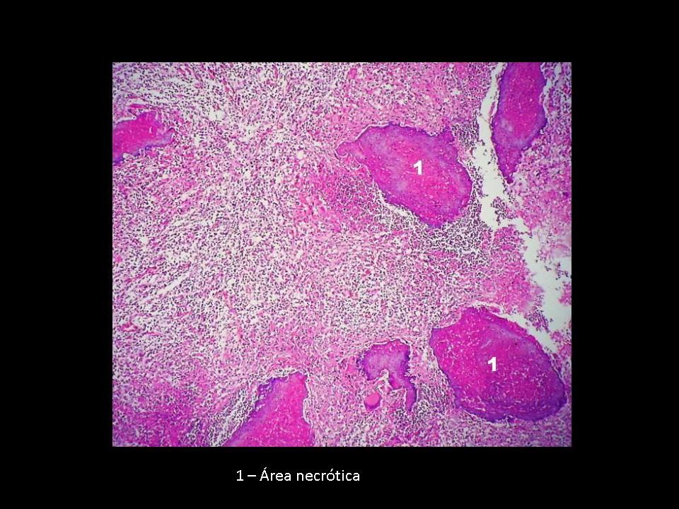 conhecendopatologia: Necrose Caseosa