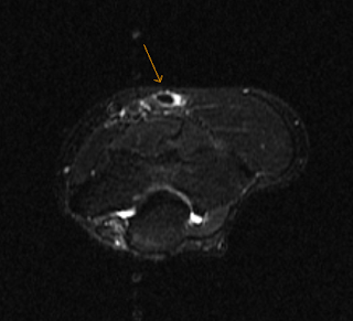 Biceps Tendon Tear-MRI - Sumer's Radiology Blog