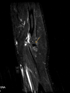 Biceps Tendon Tear-MRI - Sumer's Radiology Blog