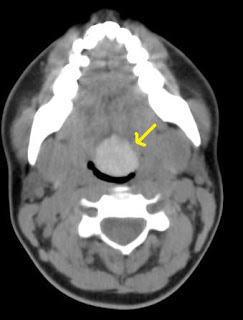 Lingual Thyroid-CT - Sumer's Radiology Blog