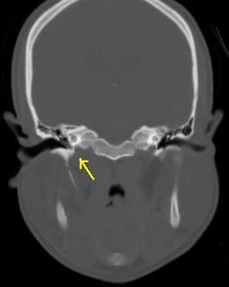 Glomus Tympaniucm-MRI &CT - Sumer's Radiology Blog