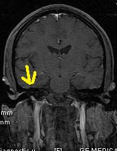Glomus Tympaniucm-MRI &CT - Sumer's Radiology Blog