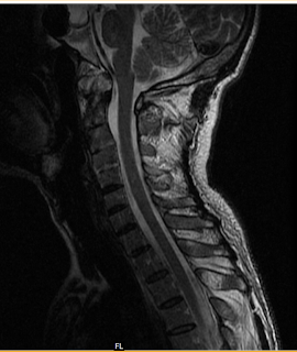 Craniovertebral Junction Involvement In Ankylosing Spondylitis-MRI ...