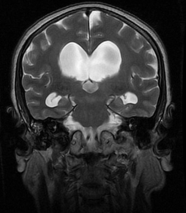 Normal Pressure Hydrocephalus-MRI - Sumer's Radiology Blog