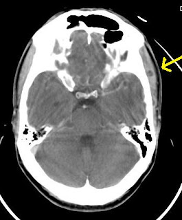 Neurocysticercosis with intramuscular cysticercosis - Sumer's Radiology ...