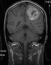 Large Intracerebral Cavernoma - Sumer's Radiology Blog