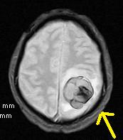 Large Intracerebral Cavernoma - Sumer's Radiology Blog