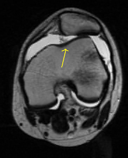 Acute Lateral Patellar Dislocation-MRI - Sumer's Radiology Blog