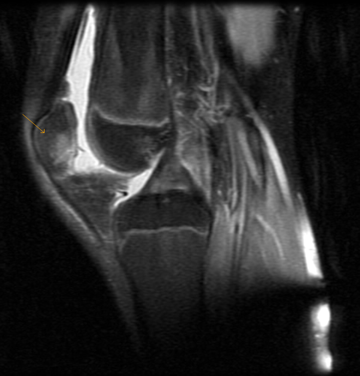 Acute Lateral Patellar Dislocation-MRI - Sumer's Radiology Blog