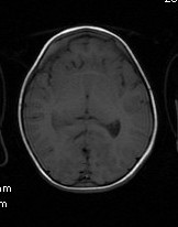 Holoprosencephaly - MRI - Sumer's Radiology Blog