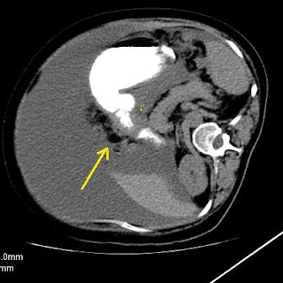 Carcinoma Stomach with Peritoneal Deposits- CT & MRI - Sumer's ...