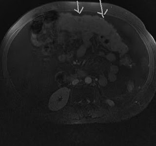 Carcinoma Stomach with Peritoneal Deposits- CT & MRI - Sumer's ...