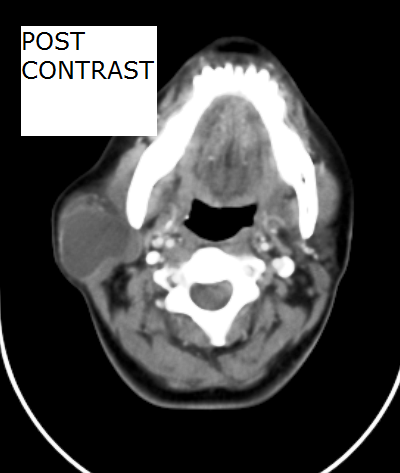First Branchial Cleft Cyst-CT - Sumer's Radiology Blog