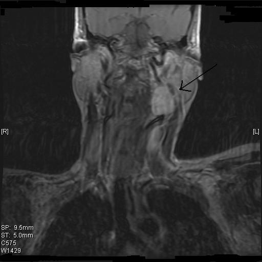 Jojos Ct Pathology Blog Carotid Body Tumors