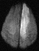 Anterior Cerebral Artery Infarct - Sumer's Radiology Blog