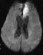Anterior Cerebral Artery Infarct - Sumer's Radiology Blog