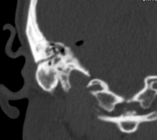 Temporal Bone Fracture-CT - Sumer's Radiology Blog