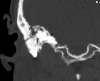 Temporal Bone Fracture-CT - Sumer's Radiology Blog