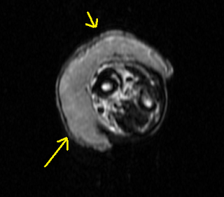 Marjolin Ulcer-MRI - Sumer's Radiology Blog