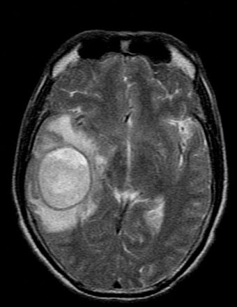 Brain Abscess-MRI - Sumer's Radiology Blog
