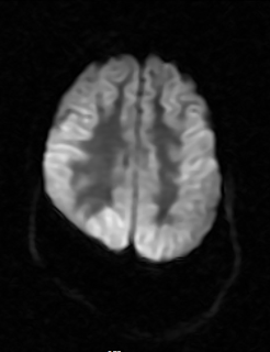 Cortical Hyperintensity on DWI - Sumer's Radiology Blog
