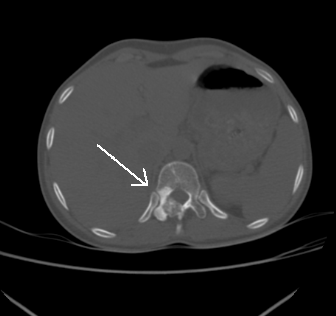 Osteoid Osteoma Dorsal Spine-CT - Sumer's Radiology Blog