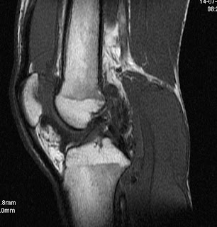 Pigmented Villonodular Synovitis-MRI - Sumer's Radiology Blog