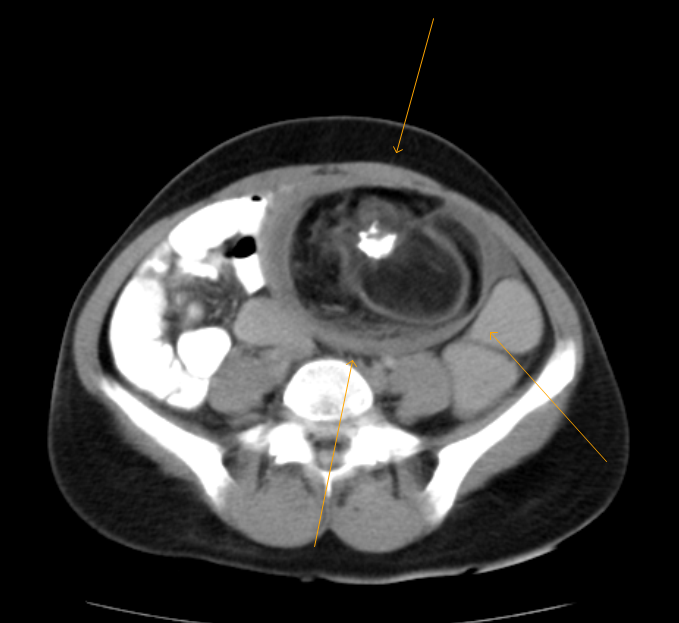 Dermoid Ovary-CT - Sumer's Radiology Blog