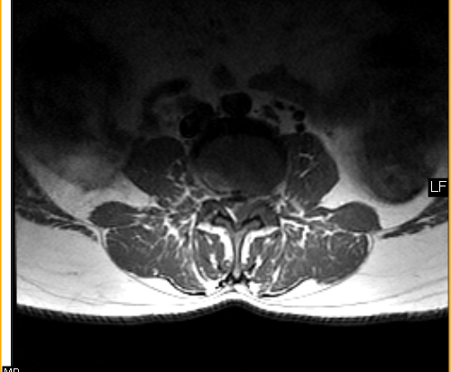 Rare Posterior Epidural Disk Sequestration-MRI - Sumer's Radiology Blog