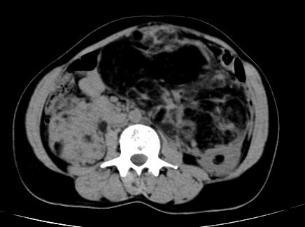 Bilateral Massive Renal Angiomyolipomatosis-CT - Sumer's Radiology Blog