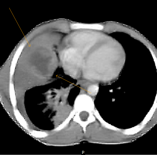 Hydatid Cyst-CT - Sumer's Radiology Blog