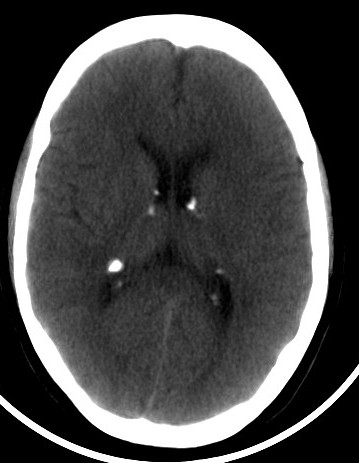 Tuberous Sclerosis - Sumer's Radiology Blog