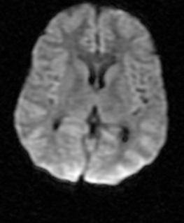 Posterior reversible encephalopathy syndrome (PRES) - Sumer's Radiology ...