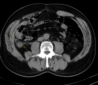 Appendicitis-CT - Sumer's Radiology Blog