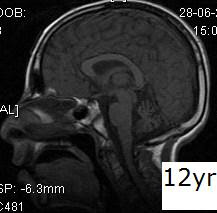 Ataxia-telangiectasia-MRI - Sumer's Radiology Blog
