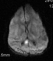 Diffuse Axonal Injury-MRI - Sumer's Radiology Blog
