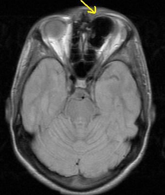 Pneumocele-Frontal Sinus with Proptosis - Sumer's Radiology Blog