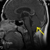 Intraventricular Cysticercosis-MRI - Sumer's Radiology Blog