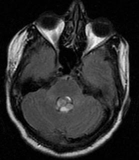 Intraventricular Cysticercosis-MRI - Sumer's Radiology Blog